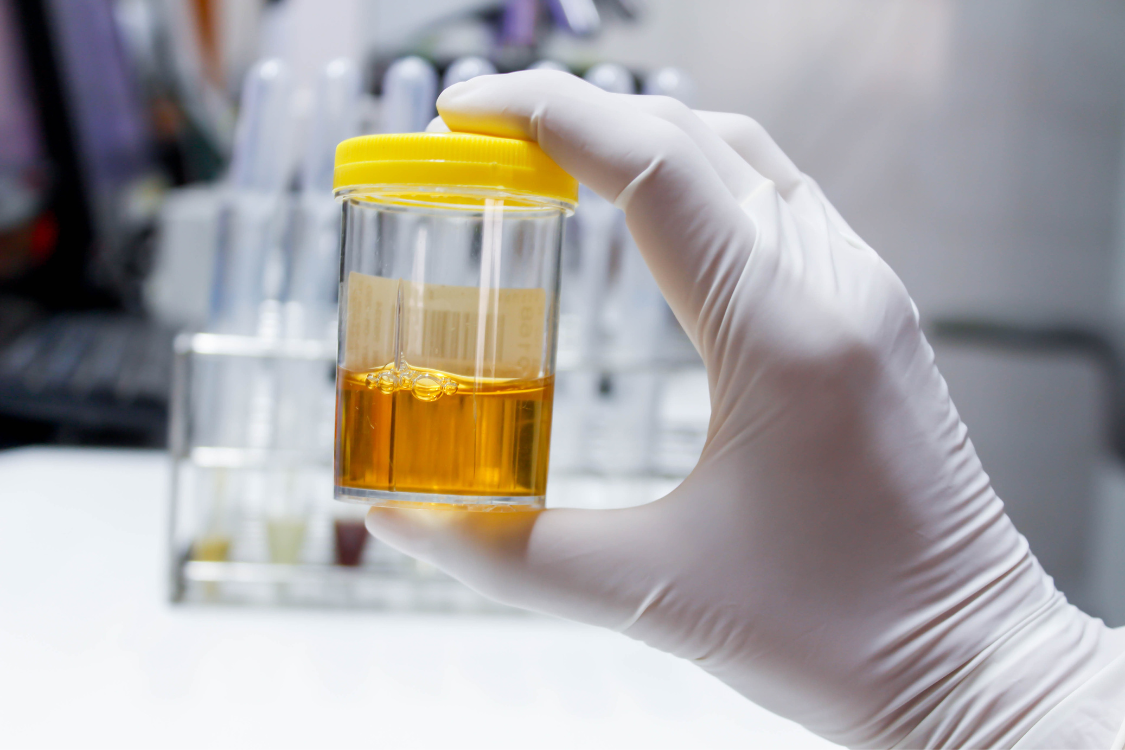 Improve Urine Flow Naturally: Tips for Better Bladder · Alerna Kidney ...
